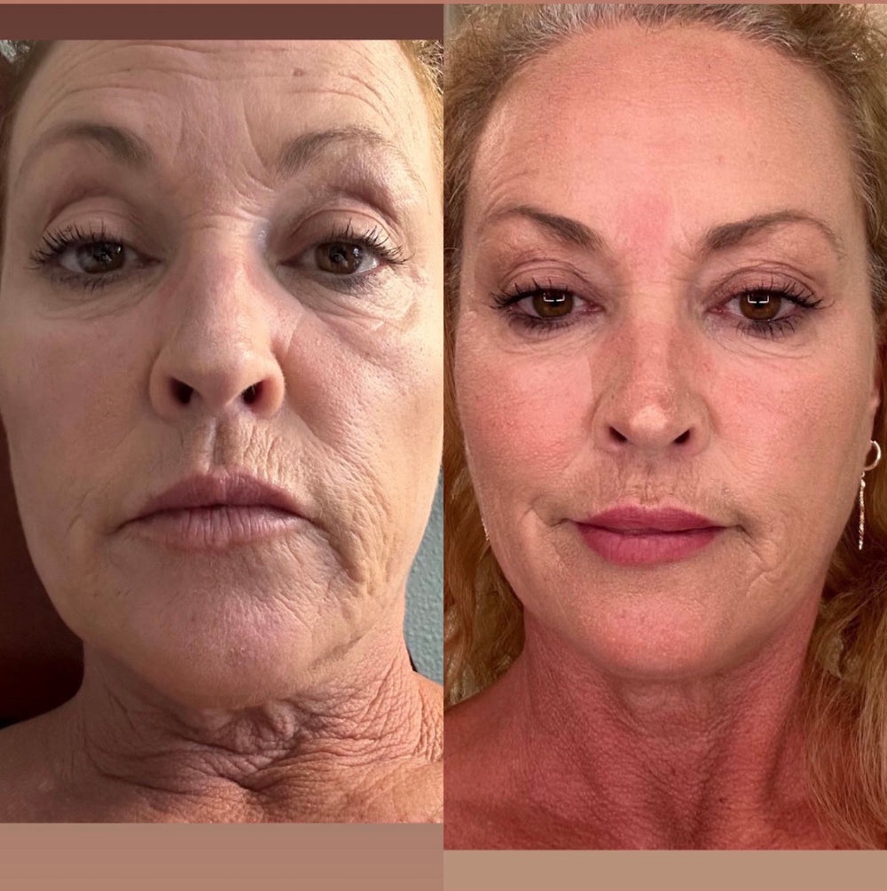 Better Than Botox Collection